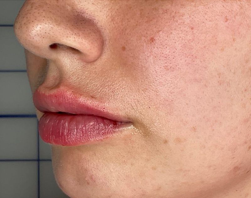 Smile Line Filler - Edgebrook Dermatology