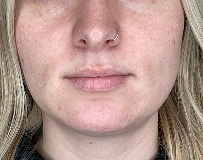 Lip Filler - Edgebrook Dermatology