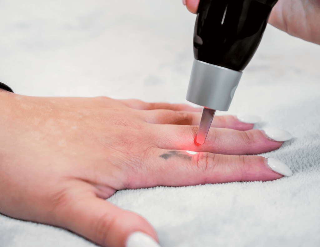 Laser Tattoo Removal Edgebrook Dermatology