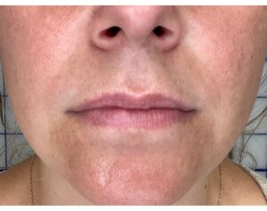 Filler: Cheeks & Nasolabial Folds (NLF) - Edgebrook Dermatology