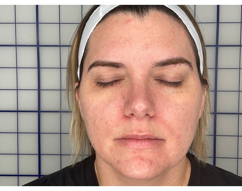 Combination Treatments - Edgebrook Dermatology