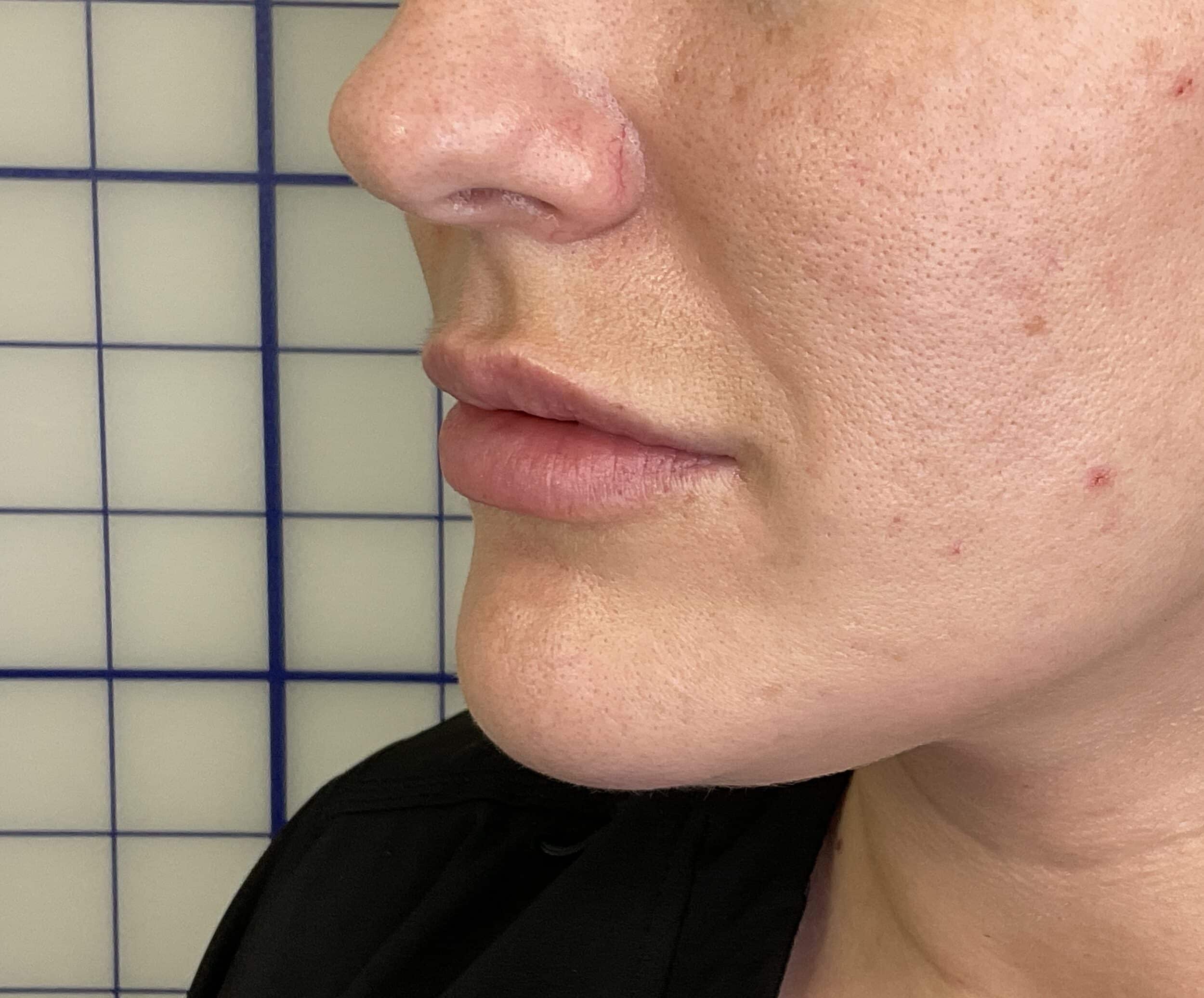 Lip Filler - Edgebrook Dermatology