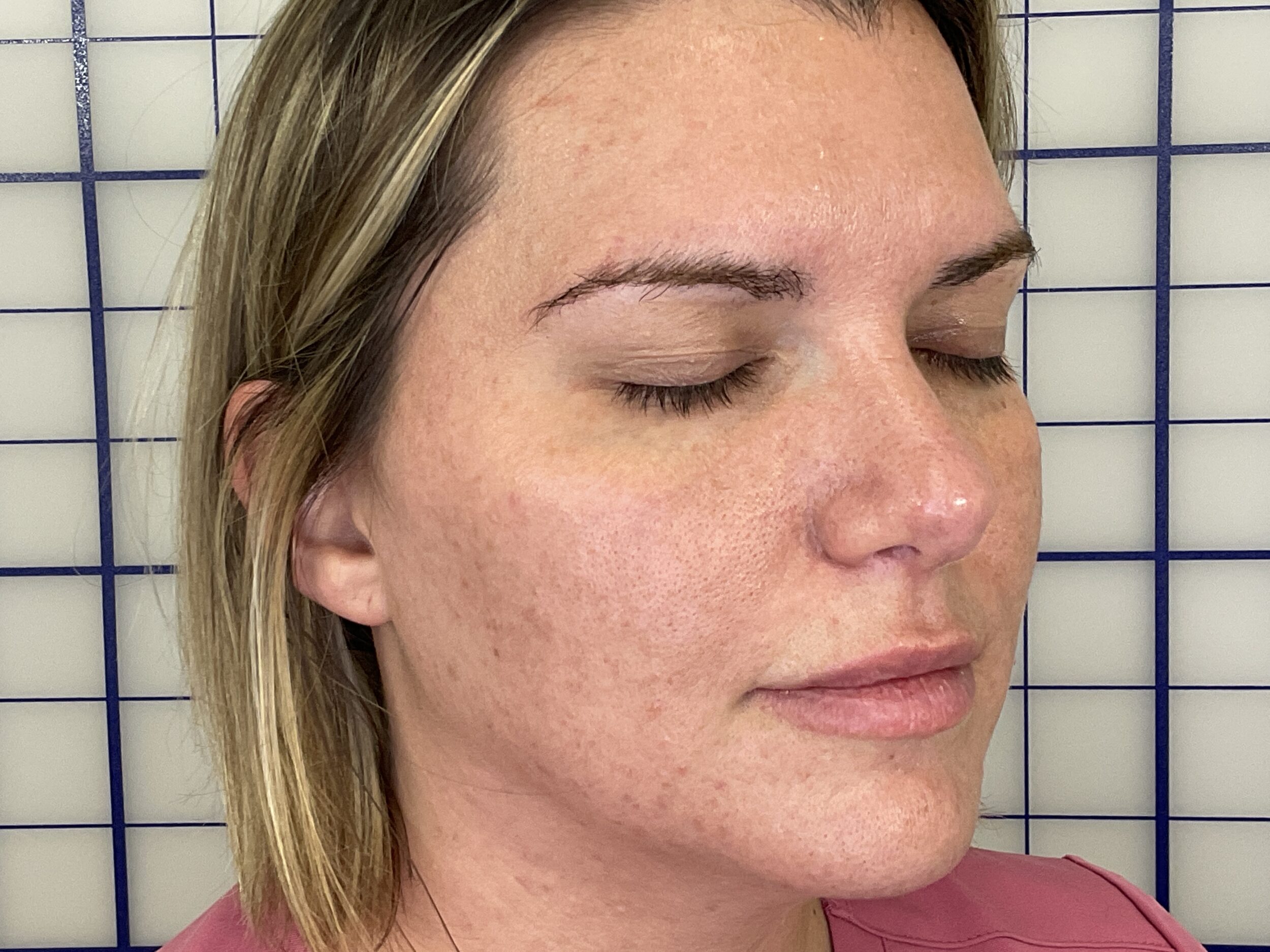 Combination Treatments - Edgebrook Dermatology