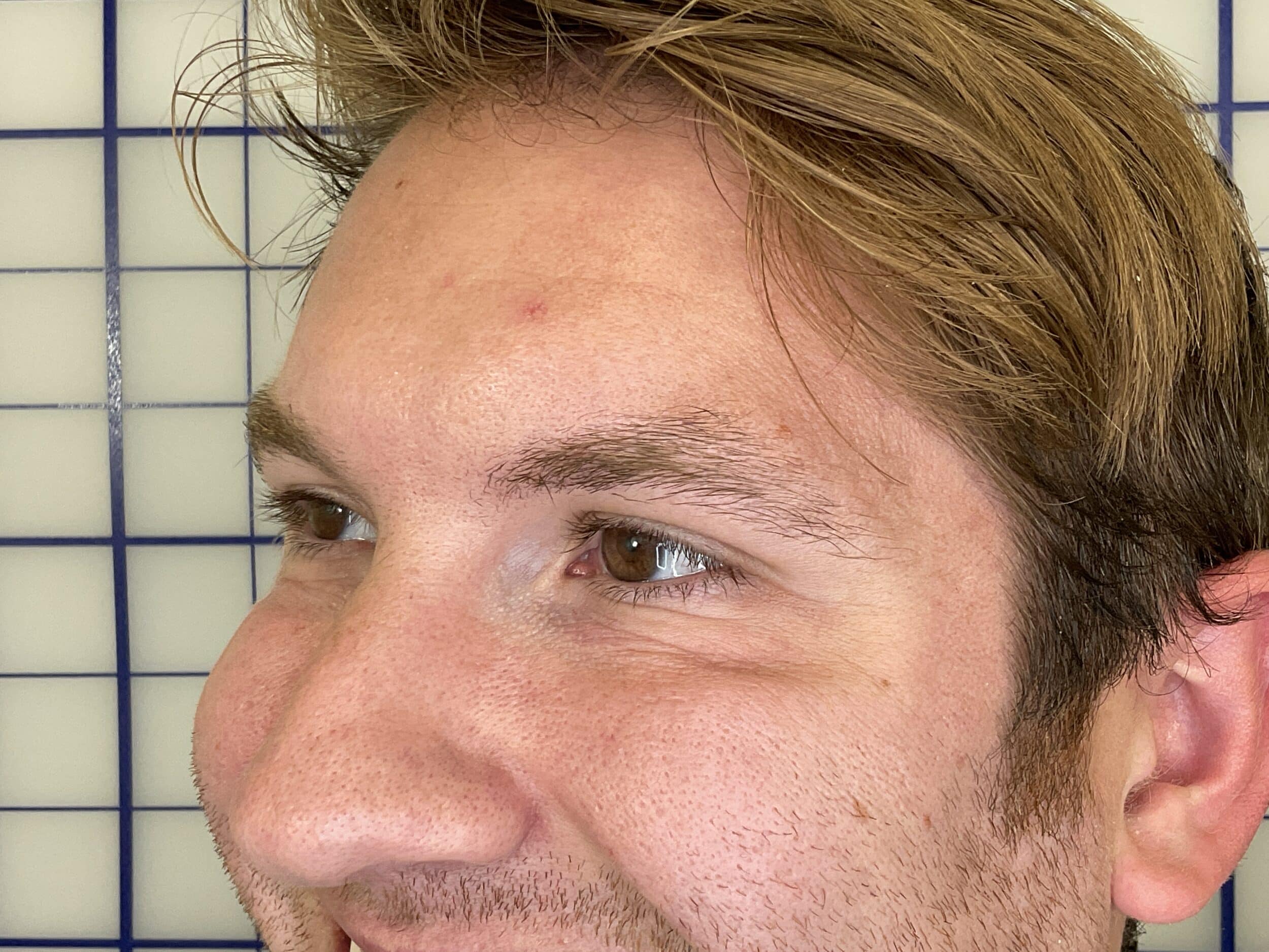 Botox - Edgebrook Dermatology