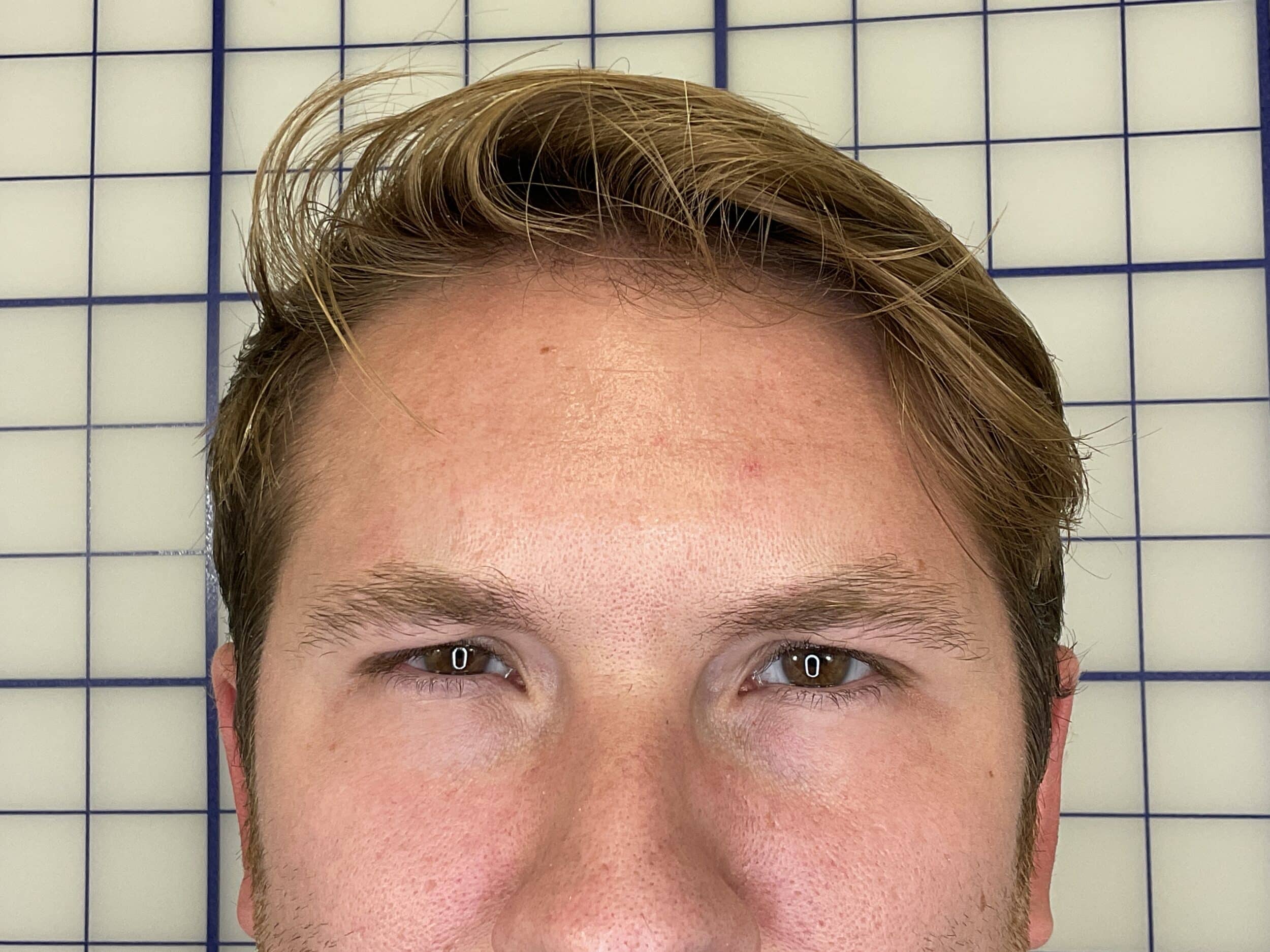 Botox - Edgebrook Dermatology