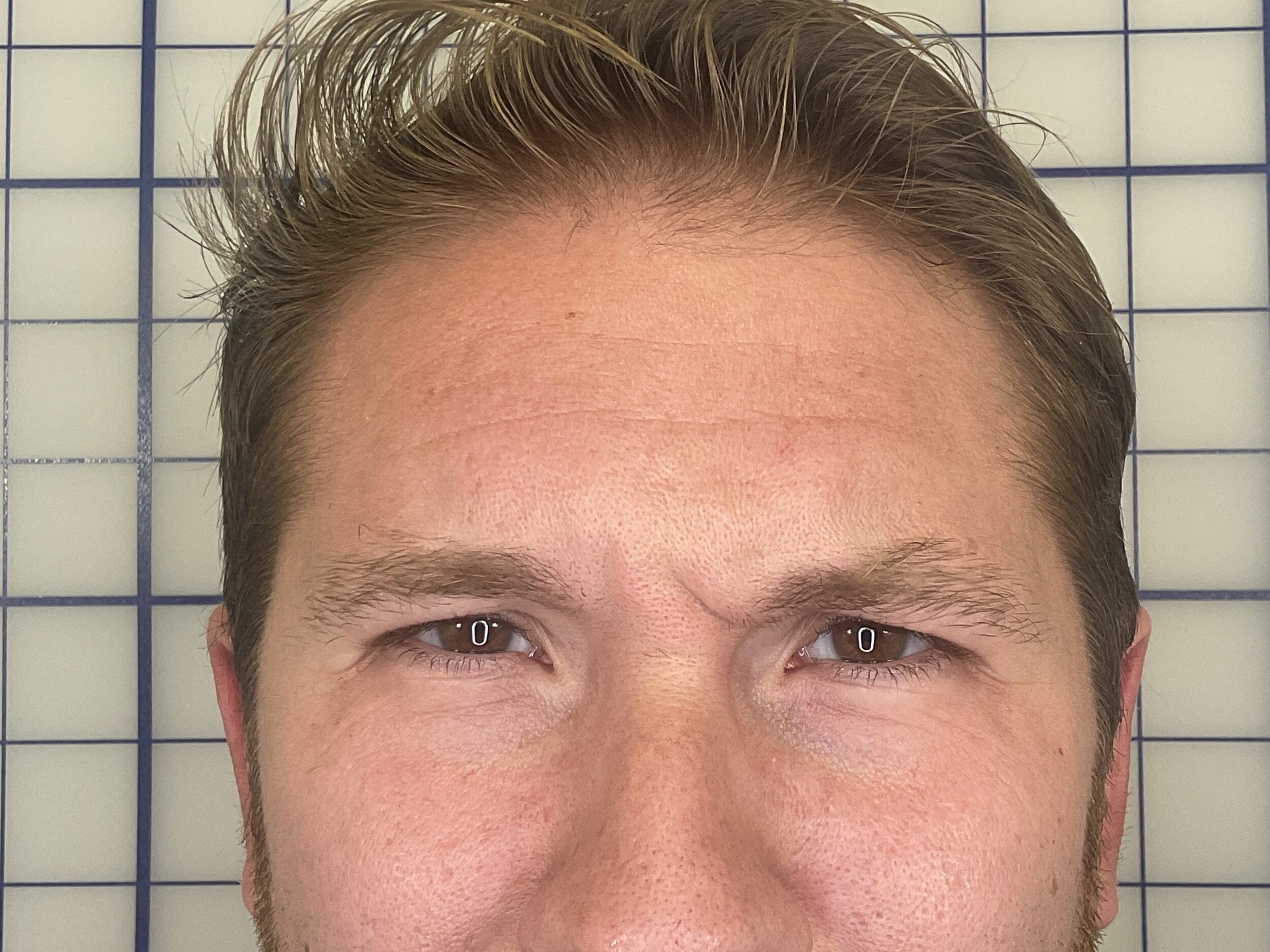 Botox Archives - Edgebrook Dermatology