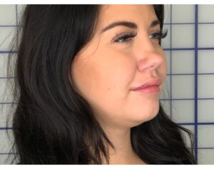 Filler: Cheeks & Nasolabial Folds (NLF) - Edgebrook Dermatology
