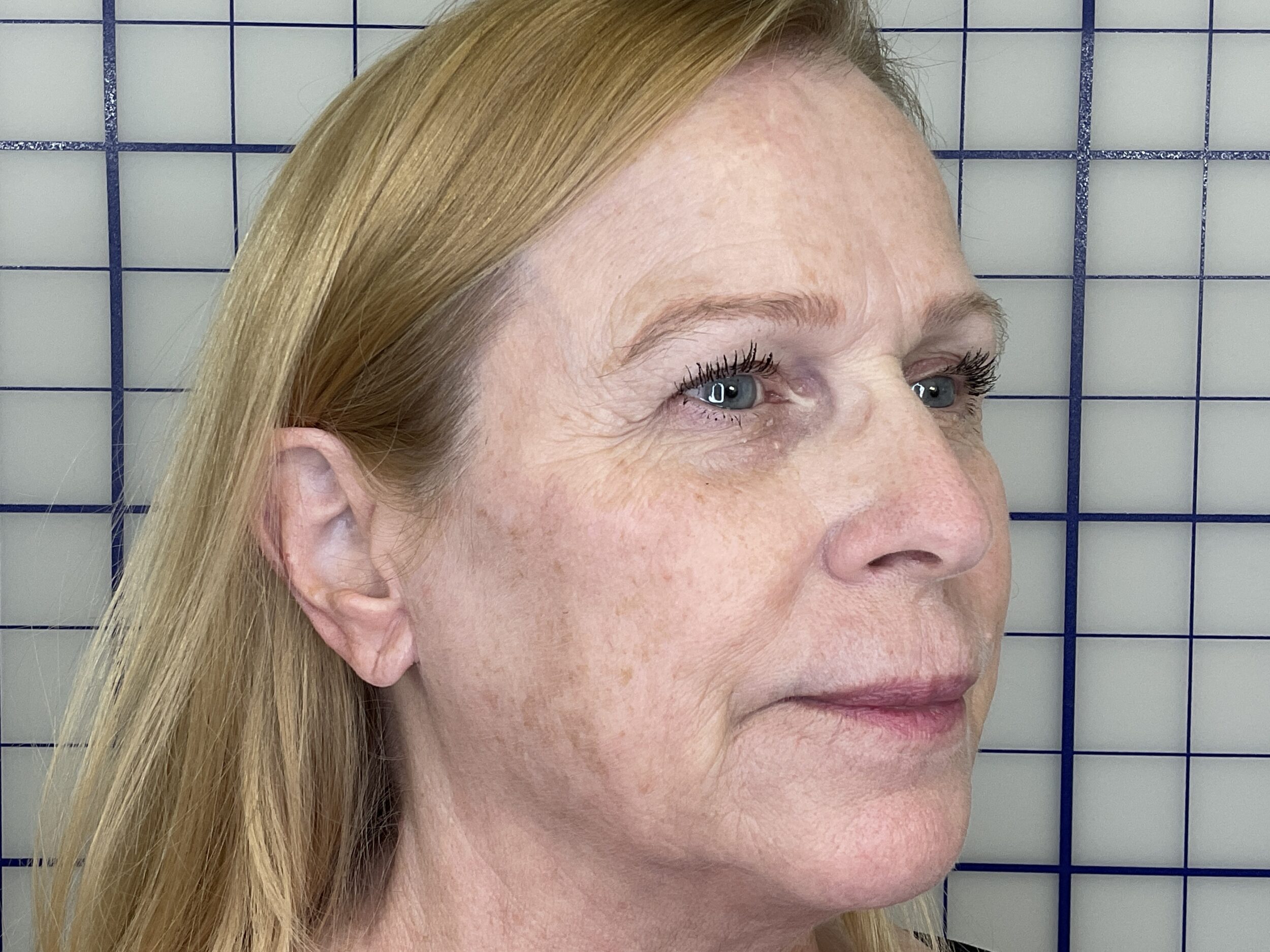 Smile Line Filler - Edgebrook Dermatology