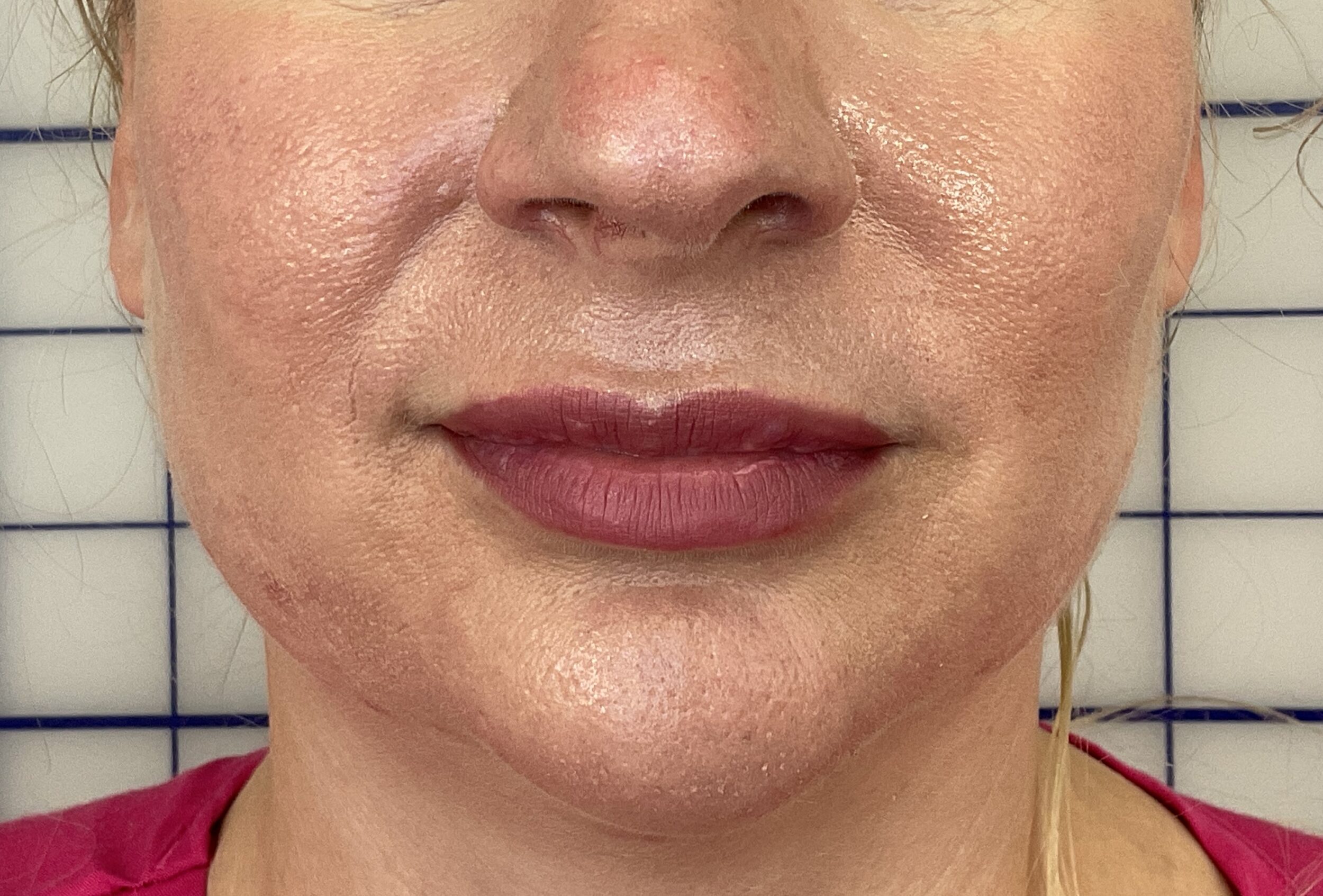 Smile Line Filler - Edgebrook Dermatology