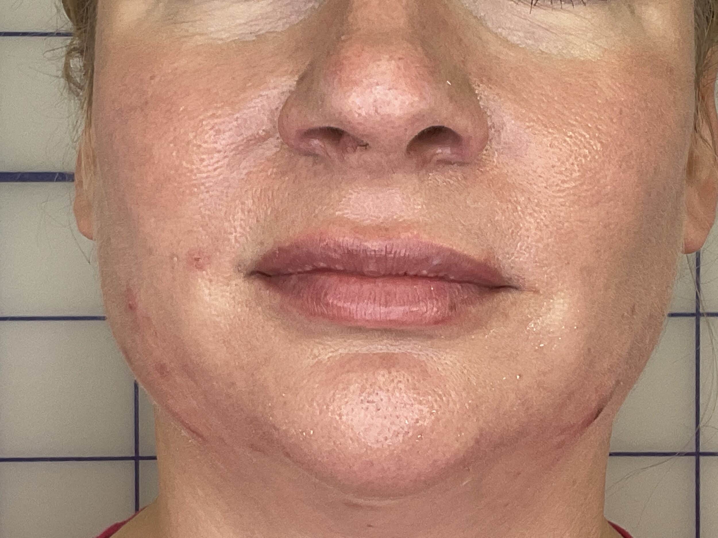 Smile Line Filler - Edgebrook Dermatology