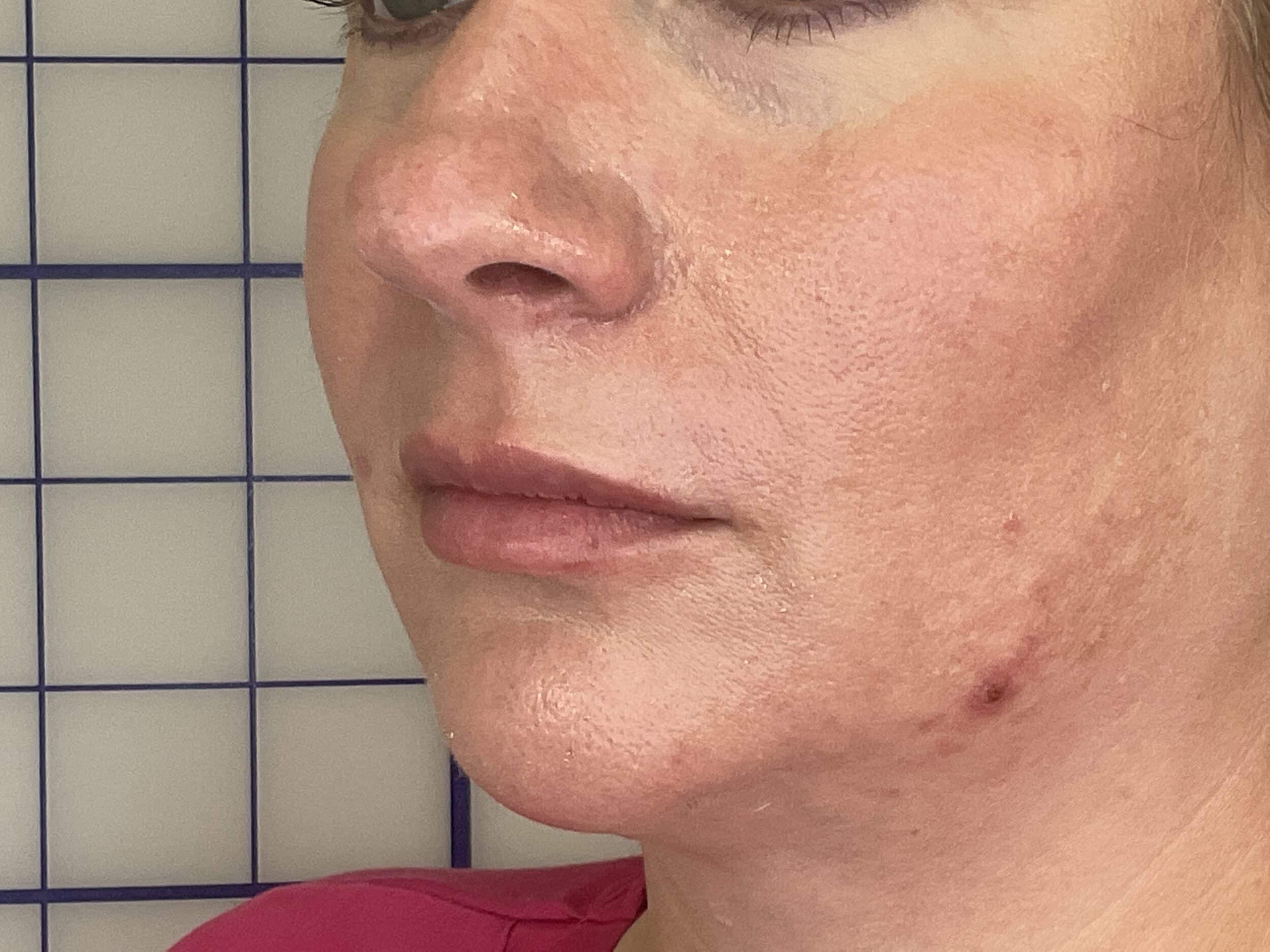 Smile Line Filler - Edgebrook Dermatology