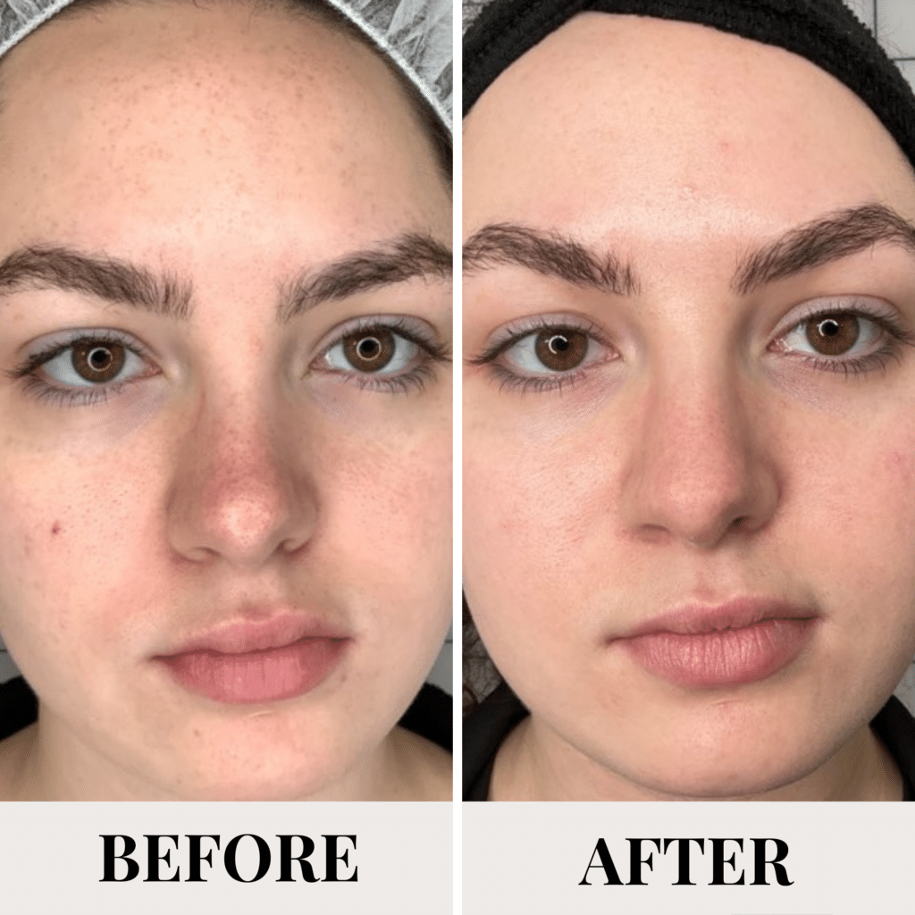 Intense Pulsed Light (IPL)