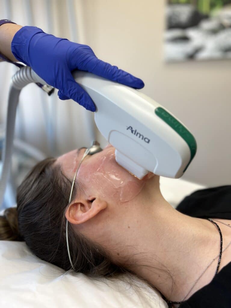 Intense Pulsed Light (IPL)